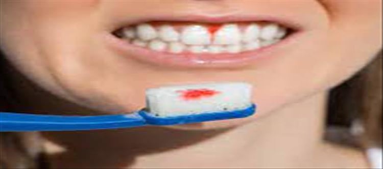 Bleeding while brushing your teeth? This may be the problem