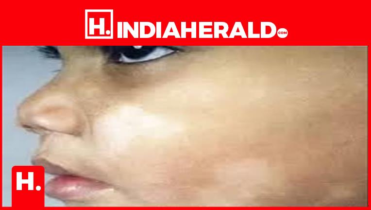 Which Vitamin Deficiency results in White Spots?