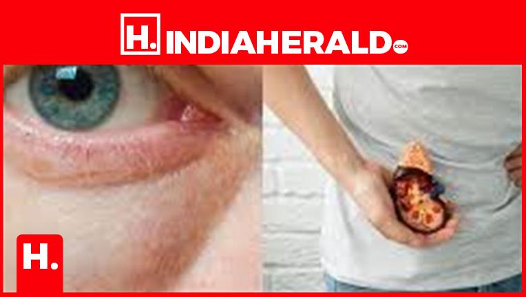 Kidney Disease Symptoms On Face And Neck: Early Warning Sig
