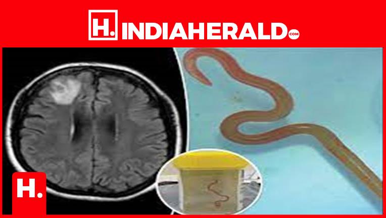 Snake in Woman s Brain? Rare Parasitic Infection Baffles Do