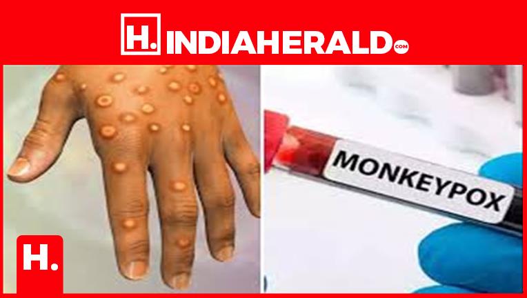 The Alarming Monkeypox.. Symptoms & Prevention..