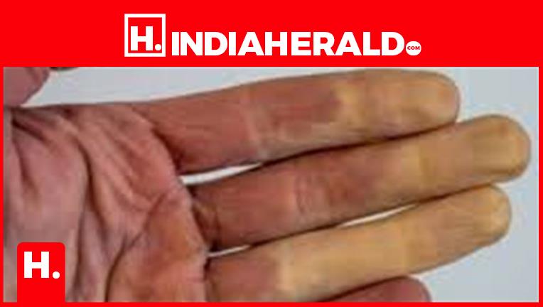 Unusual Symptoms of Rheumatoid Arthritis You Shouldn’t Igno