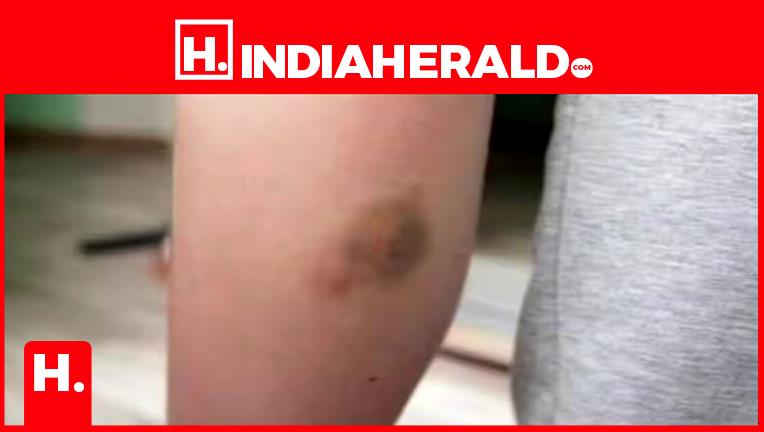 If you have blue marks on your body after injury, try these