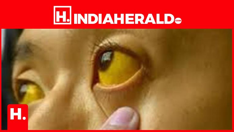 Signs Of Kidney Disease Visible On Face And Neck