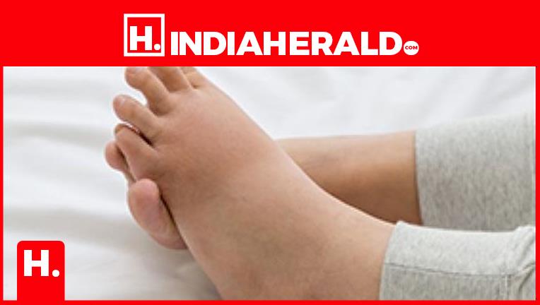 3 symptoms of high uric acid signs