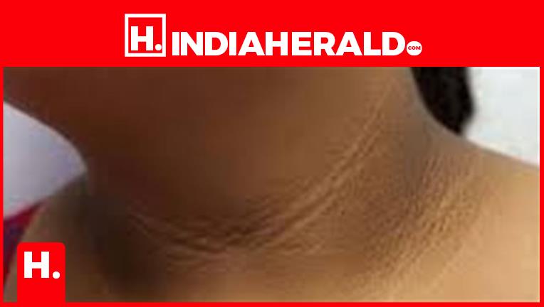 Darkish Ring Around Your Neck?