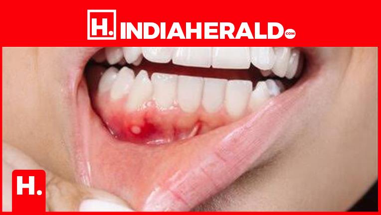 Effective Ways to Treat and Prevent Canker Sores.