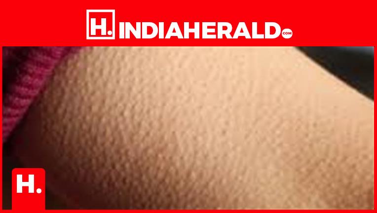 Goosebumps: What They May Be And Why We Get Them