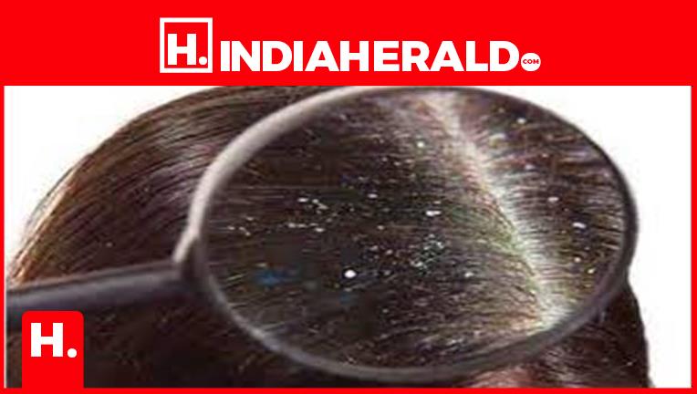 How to get rid of dandruff in winter..