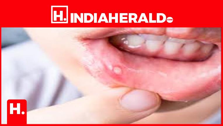 How to treat mouth ulcer at home?