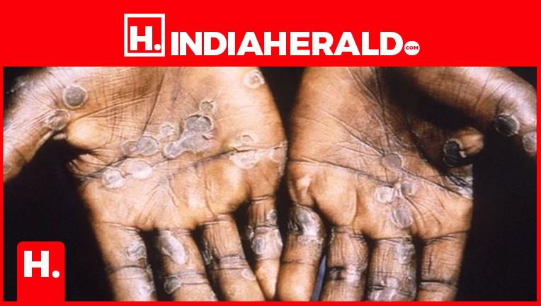 Monkey pox scare over in AP
