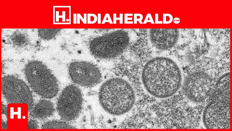 Monkeypox cases increases day by day