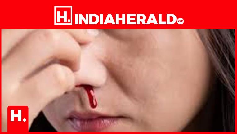 Nose bleeding starts in summer, treat it with these tips