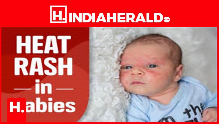 Home remedies to get rid of Heat Rash?...