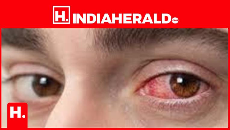 How to avoid eye bacteria during monsoon?Take care in this