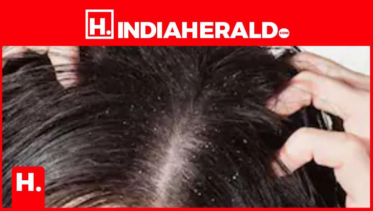 How To Tackle Dry Scalp And Flakes In Cold Weather ...?