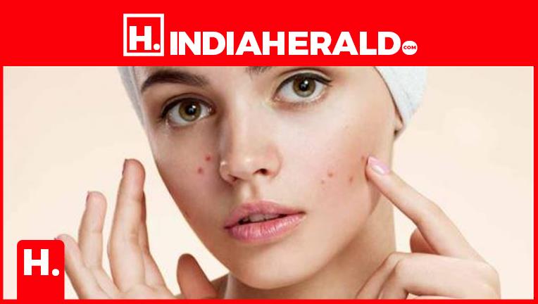 Know How Poor Gut Fitness Contributes To Pimples And What A