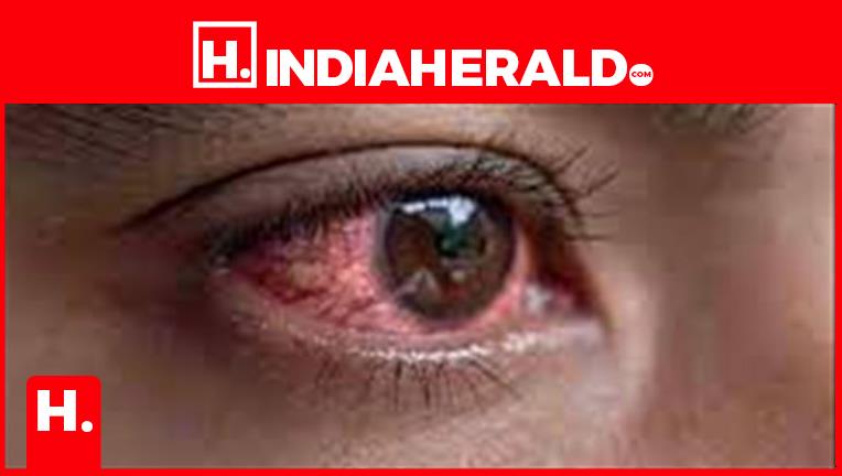 Health: What is the symptoms of eye flu?