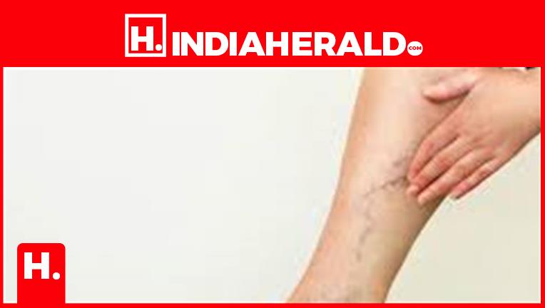 5 Signs Your Legs Reveal About Potential Vein Disease Issue