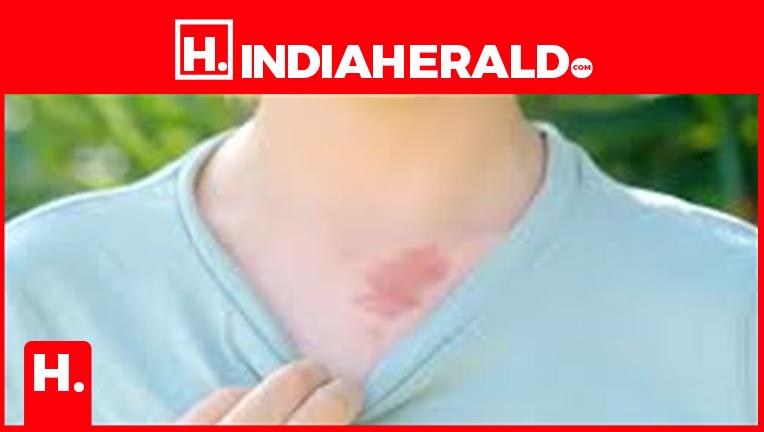 Birthmarks: Marks on Your Body Reveal the Secrets of Your P