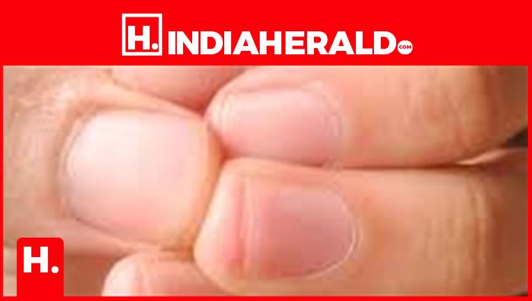 Test Your Hands For Signs And Symptoms Of High Ldl Choleste