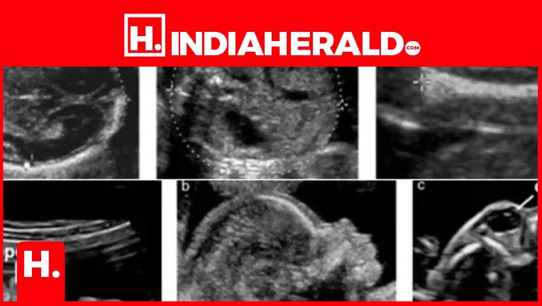 What Are Fetal Abnormalities, And What Are Their Causes?